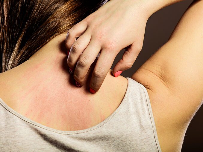 Pflasterallergie im Griff: Ursachen, Pflege und Vorbeugung - Senioren ...